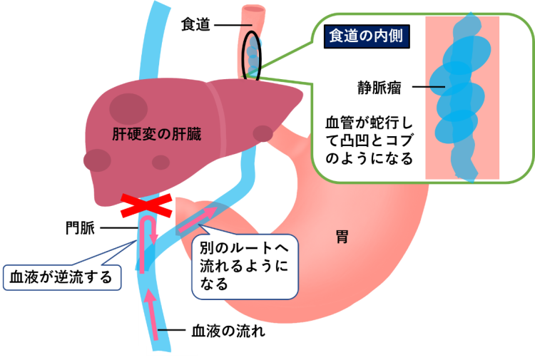 食道静脈瘤 | しおや消化器内科クリニック | さいたま市中央区 与野本町駅